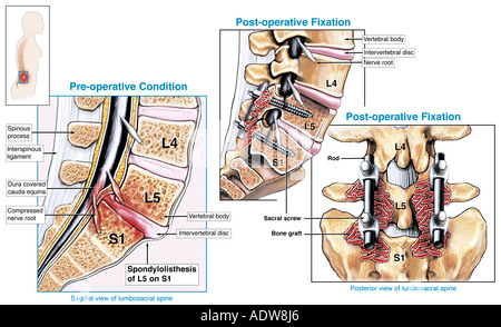 Spine Surgery - L5-S1 Spondylolisthesis with Spinal Cord Stock Photo, Royalty Free Image ...