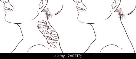 Woman Symptom Buffalo Hump Illustration Stock Vector Image & Art - Alamy