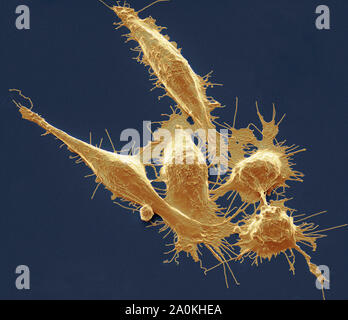 Colorectal cancer cell. Coloured scanning electron micrograph (SEM) of ...