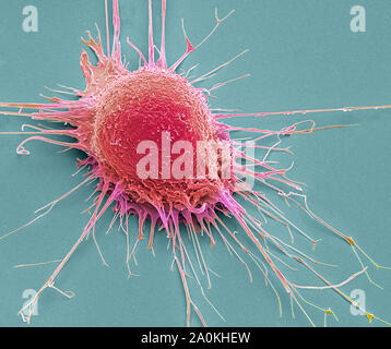 Prostate cancer cell. Coloured scanning electron (SEM) micrograph of a ...