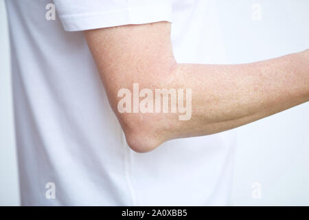 Swelling associated with Bursitis of the elbow Stock Photo - Alamy