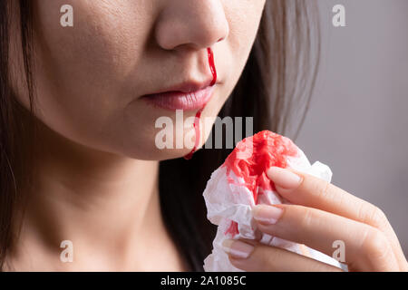 Wound nosebleed, woman bleeding from her nose, nose injury blood and ...