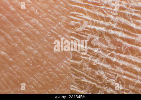 Large plaque parapsoriasis super macro on caucasian man legs Stock ...