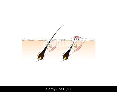 Ingrown Hair Problem Treatment vector seamless pattern Stock Vector ...