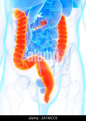Ulcerative colitis as an inflammatory intestine with healthy and ...