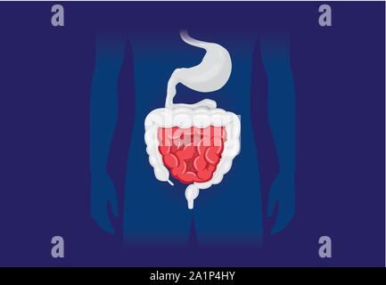 Illustration about abnormal symptom of human large Intestine Stock ...