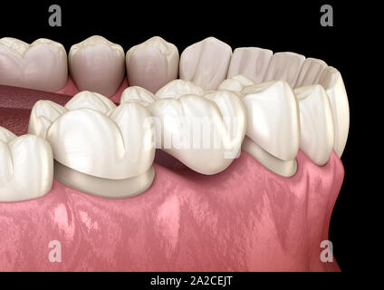 Dental bridge of 3 teeth over molar and premolar. Medically accurate 3D ...