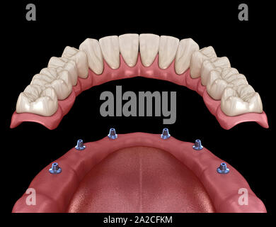 Removable Mandibular prosthesis with gum All on 4 system supported by ...