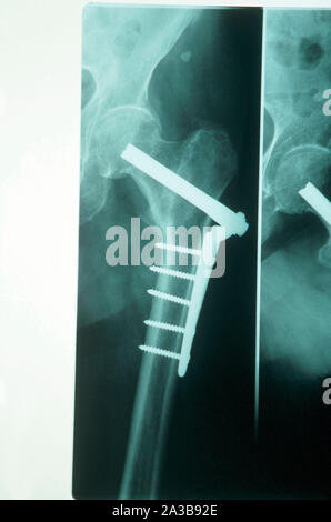 x-rays, prosthesis, hip Stock Photo - Alamy
