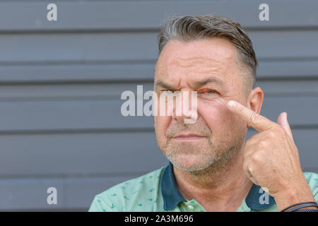 Man pointing to an inflamed eye caused by a bacterial infection, stye ...