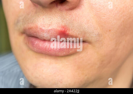 Cold sore blister red pimple on upper lips of woman with herpes. Design ...