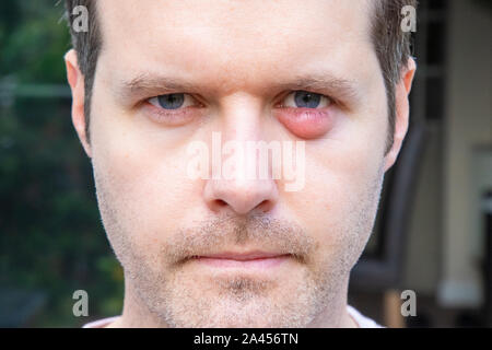 A man with a swollen eyelid due to an infection Stock Photo - Alamy