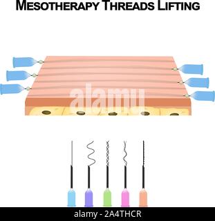 Types of threads for facelift. Mesotherapy Threads Lifting. The ...