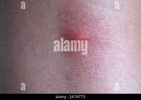 Skin texture painful in red blisters skin rashes after chemical burn ...