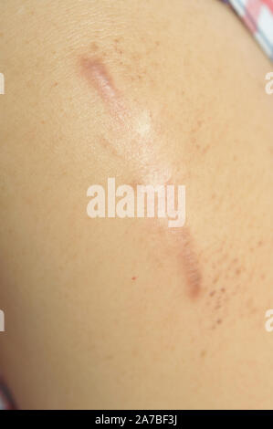 Closeup Scars On Abdomen After Removal Of Appendicitis And Abdominal ...