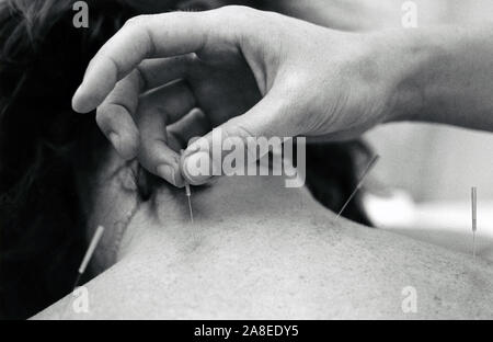 Acupuncture, UK 1990s Stock Photo - Alamy