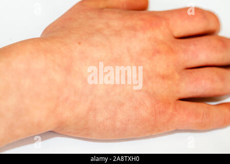 Erythema ab igne or heat dermatitis also known as hot water bottle rash ...