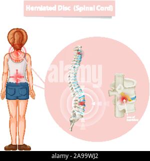 Diagram showing herniated Disc illustration Stock Vector Image & Art ...