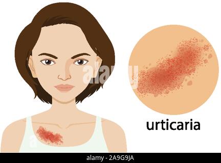 Diagram showing urticaria on human female Stock Vector Image & Art - Alamy