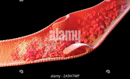 Blood clot and thrombosis medical illustration concept as a group of ...