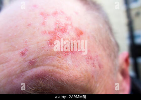 Forehead / head and scalp of a man whose Actinic Keratosis skin lesions ...