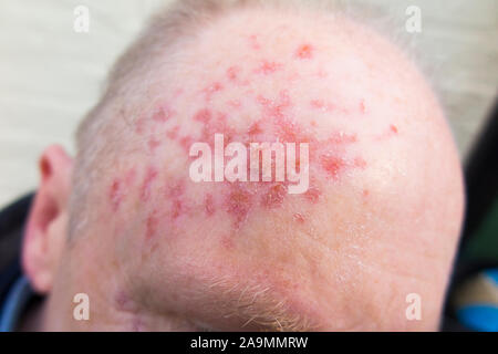 man sun damage treatment Stock Photo: 84884814 - Alamy