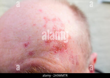 Keratoacanthoma, Skin precancerous lesion ,Light microscopy Stock Photo ...