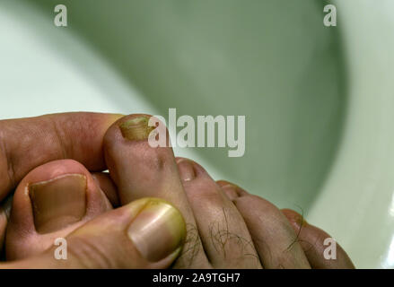 dirty infected foot mycosis on white background Stock Photo - Alamy