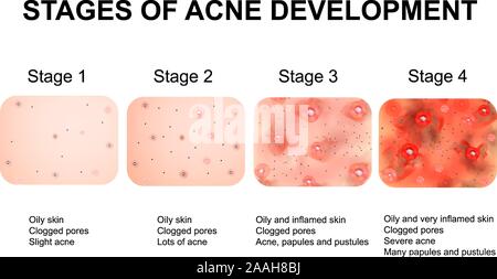 Stages of development of acne. Inflamed skin with scars, acne and ...