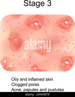 Stage 1 of development of acne. Inflamed skin with scars, acne and ...