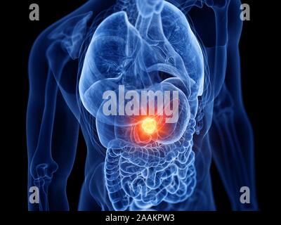 Pancreas cancer, computer illustration Stock Photo - Alamy