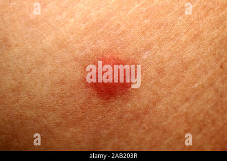 The leg with red spot caused by insect bite / Insect bite on leg skin ...