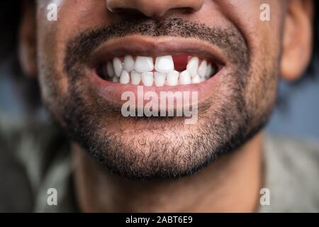 Man with missing front tooth Stock Photo: 38105452 - Alamy