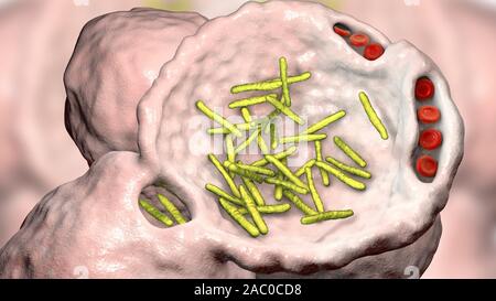 Bacterial pneumonia. Computer illustration of rod-shaped bacteria ...