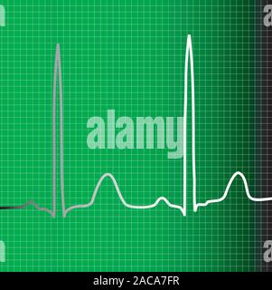 ECG. Computer illustration of an electrocardiogram (ECG) showing a ...
