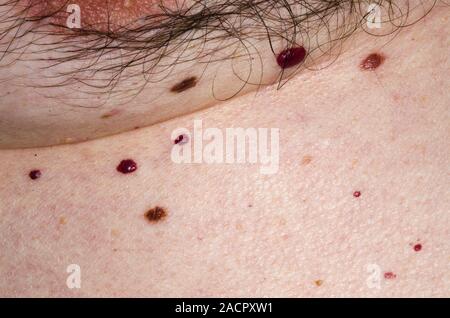 Cherry Angioma Chest