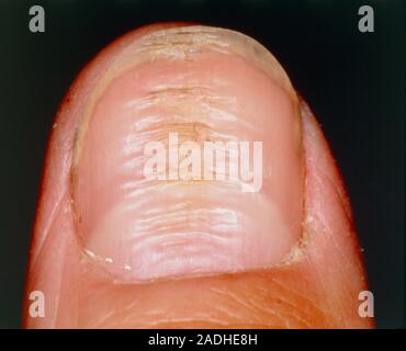 What Causes Horizontal Ridges In Fingernails
