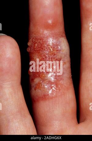 herpes on finger causes
