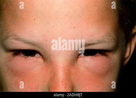 Severe hay fever store