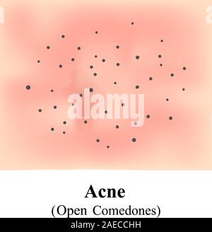 Types of acne. Closed comedones, open comedones, inflamed acne, cysts ...