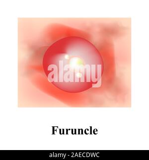 Pustules on the skin. Cystic acne. Pimples on the skin background ...