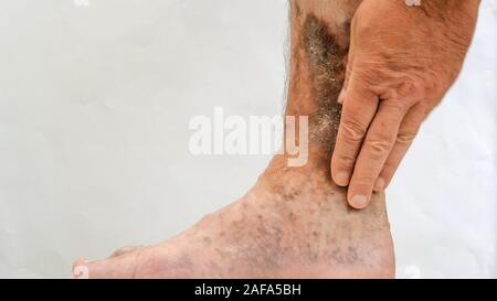 Skin ulcer close up on the top of foot from being in a cast. Pressure ...