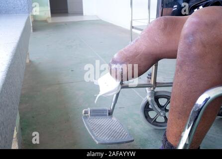 BKA stump with small wound at stump Stock Photo - Alamy
