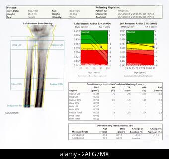 Bone Density Scan and chart of the forearm showing the ulna and radius ...
