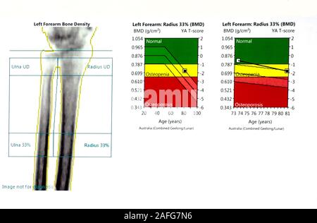 Bone Density Scan of forearm of a female patient aged 80 Stock Photo ...