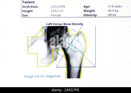Left Femur Bone Density Scan and comparison chart of a female aged 80 ...