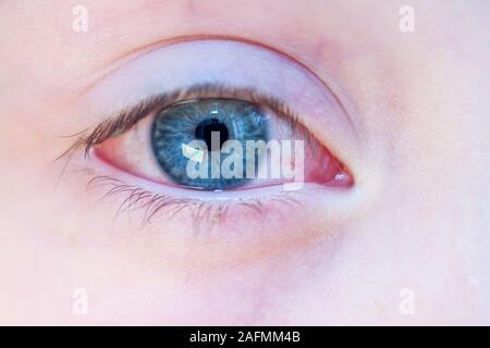 Close Up of irritated red blood eye Stock Photo - Alamy