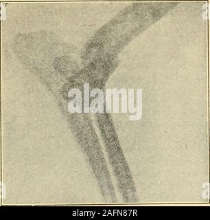 The treatment of fractures . Line of fracture. Fig. 559.—Fracture of ...