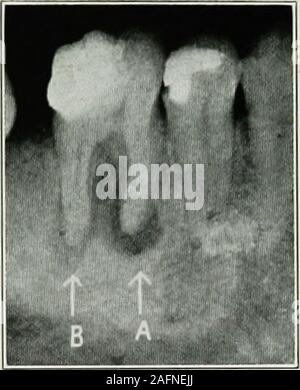 . Dental electro-therapeutics. Abscess on lower molar showing ex ...