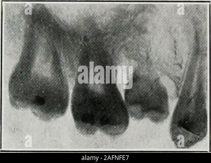 . Dental electro-therapeutics. Fig. 94 Fig. 95 12 178 THE X-RAYS OR ...